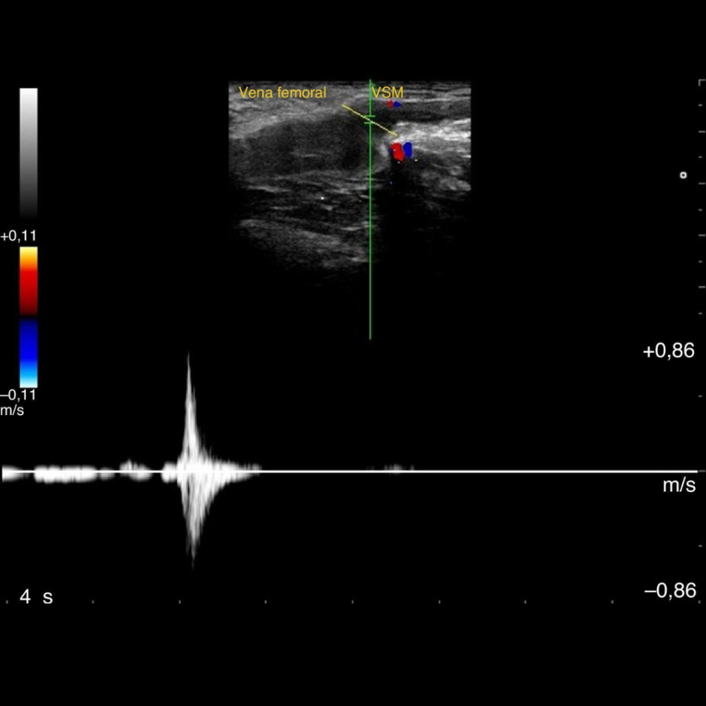 Ecografía Doppler Vascular | ECOdiagnóstico